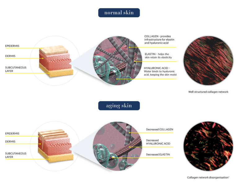 Ellanse Dermal Fillers 少女针 | Mizu Aesthetic Clinic Singapore