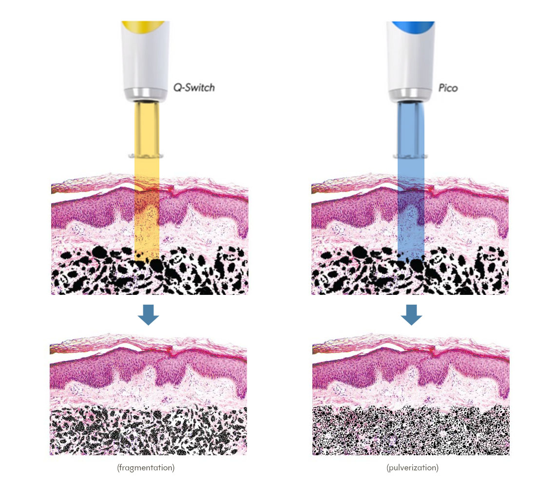 Discovery Pico Second Laser | Mizu Aesthetic Clinic Singapore